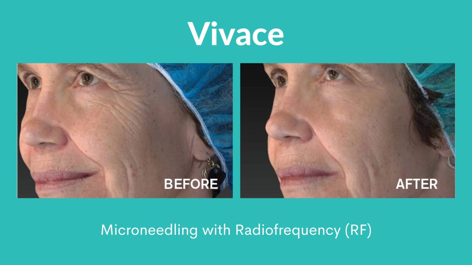 Microneedling with Radiofrequency - Dermatology Center of Atlanta