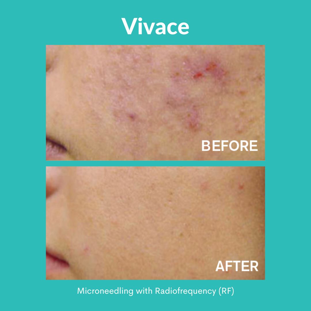 Microneedling with Radiofrequency - Dermatology Center of Atlanta